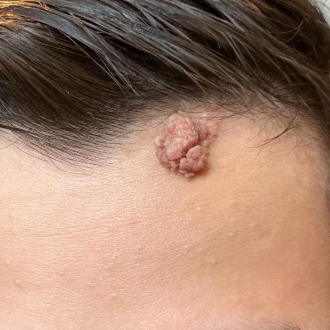 What Causes Warts On Face Nhs Uk Infoupdate What Causes Warts On Face Nhs Uk Infoupdate