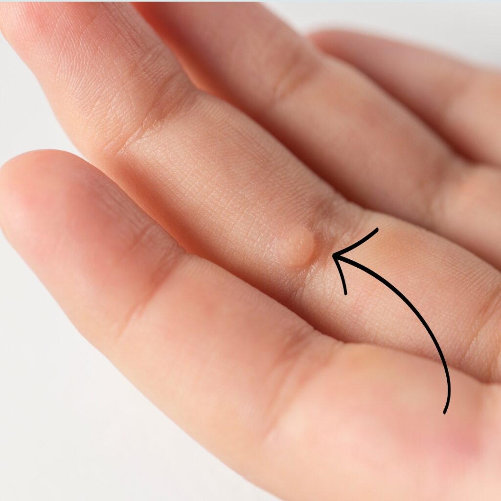 First Signs Of Warts On Hands Infoupdate First Signs Of Warts On Hands Infoupdate