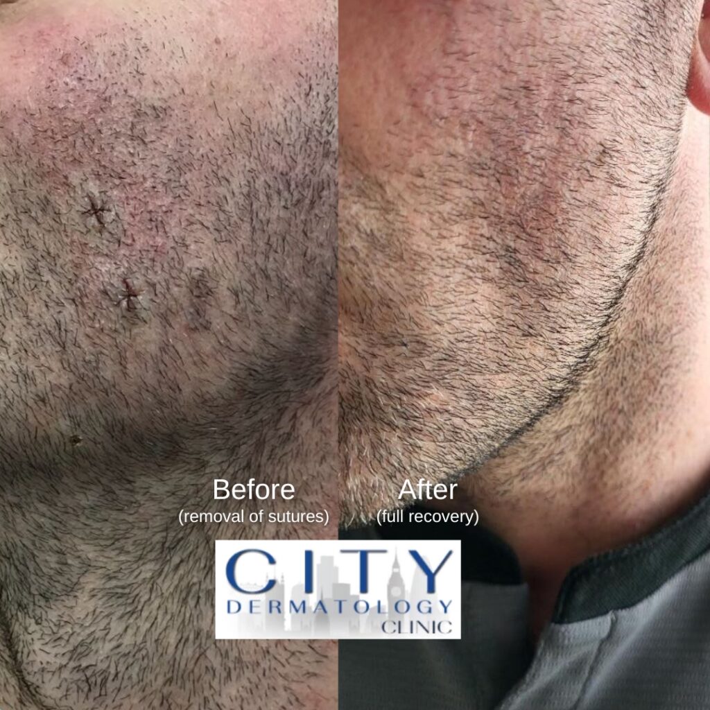 Mole Removal in London from £275 | Same Day Treatment