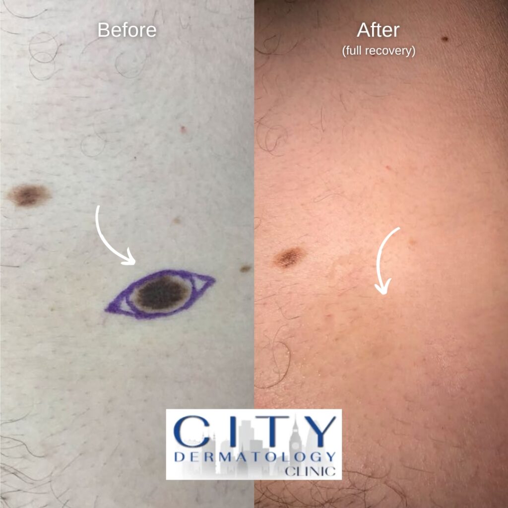 Mole Removal in London from £275 | Same Day Treatment