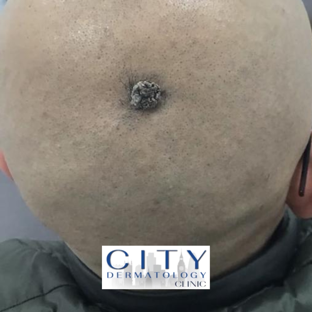 Wart Removal in London from £295 | Same Day Treatment