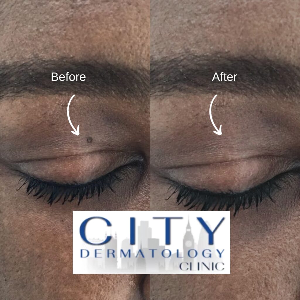Eyelid Skin Tag Removal London from £275 | Same Day Treatment