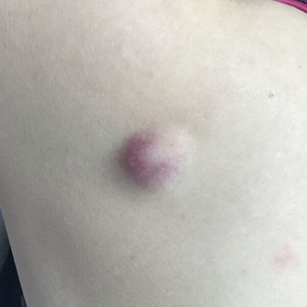 Cyst Removal in London - Same Day Treatment from £295
