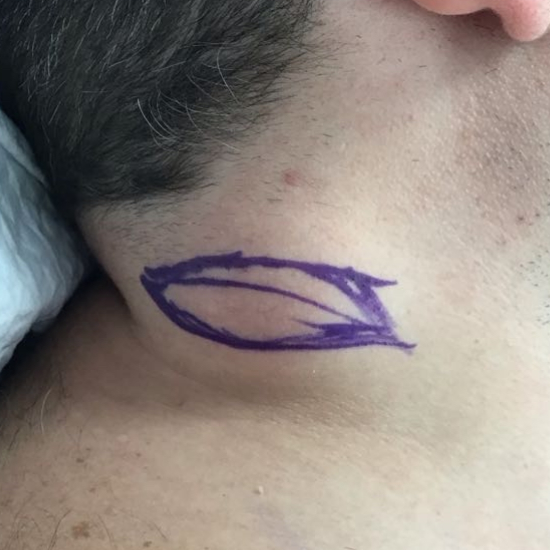 Lipoma Removal in London