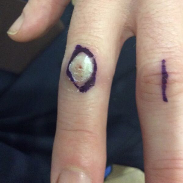 Types of Warts on Fingers: Identification and Treatment