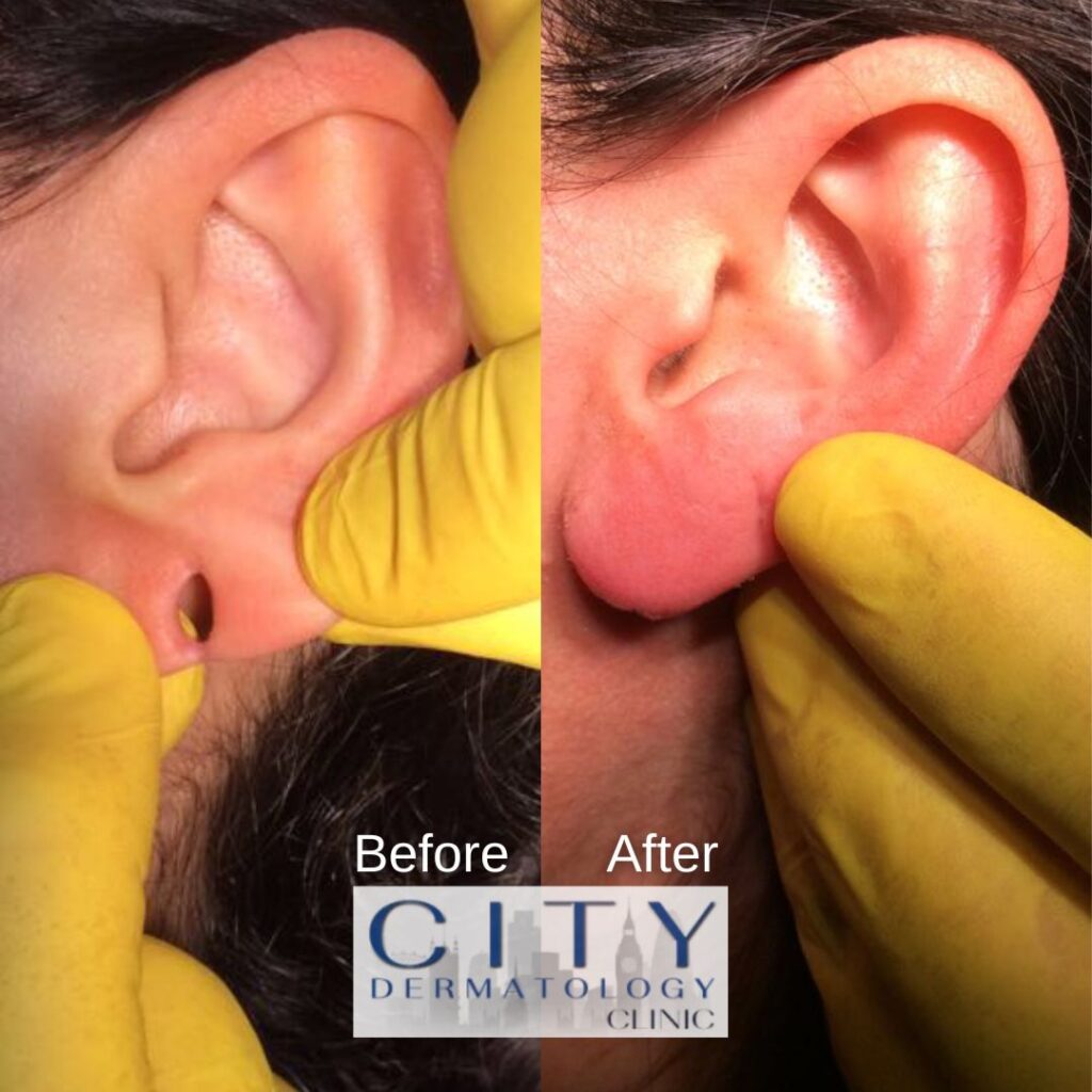 Split Earlobe Repair in London (£595)