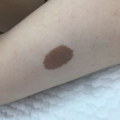 Birthmark Removal in London from £395 | Same Day Treatment