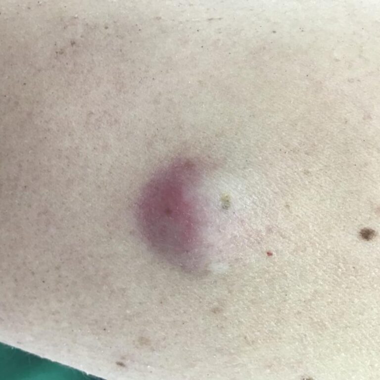 Pictures of Cysts Under the Skin | Common Types & Examples