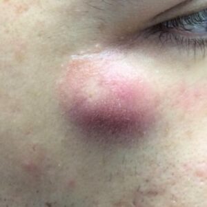 Pictures of Cysts Under the Skin | Common Types & Examples