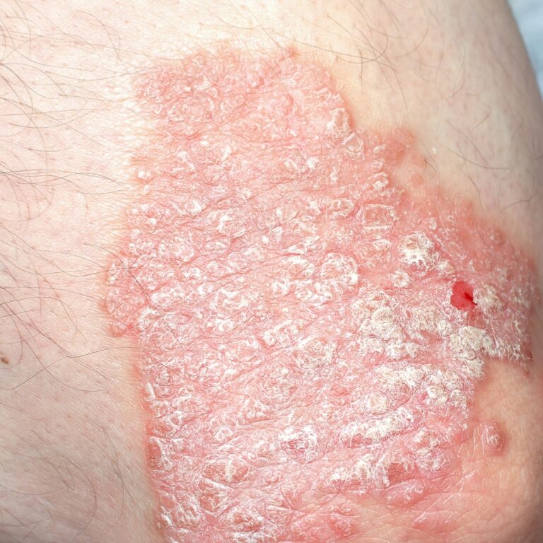 Psoriasis Causes and Treatment - Expert Advice for Managing Symptoms