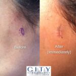 Before & After Photos Cyst Removal