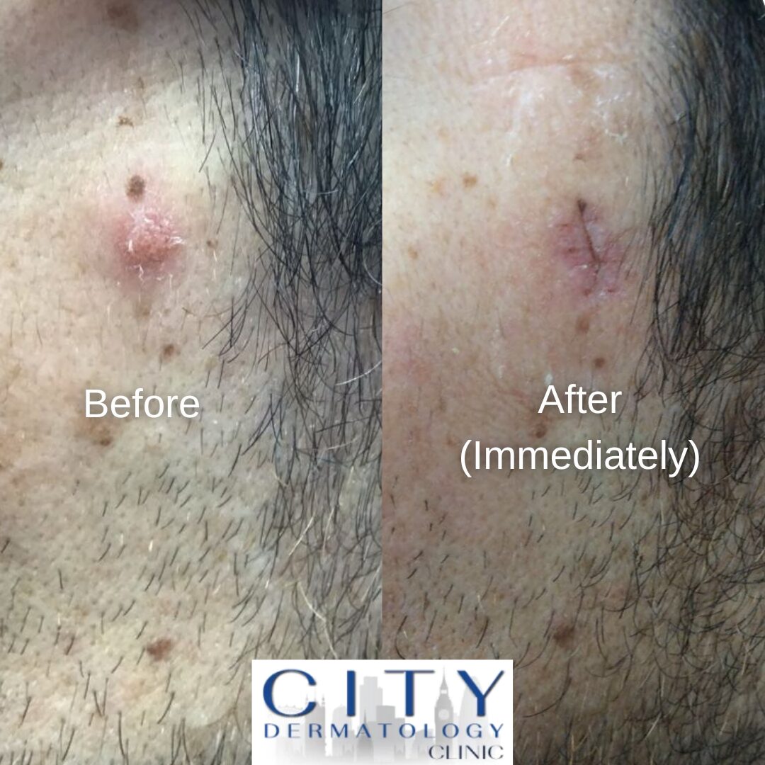 Before & After Photos Cyst Removal
