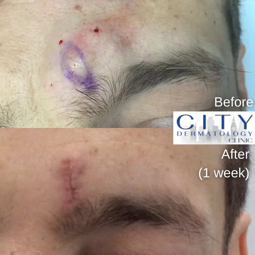 Before After Photos Cyst Removal
