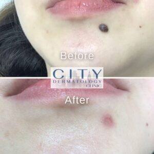 Before and After Photos Mole Removals