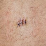 Does Cyst Removal Leave a Scar? Expert Advice on Scarring and Healing