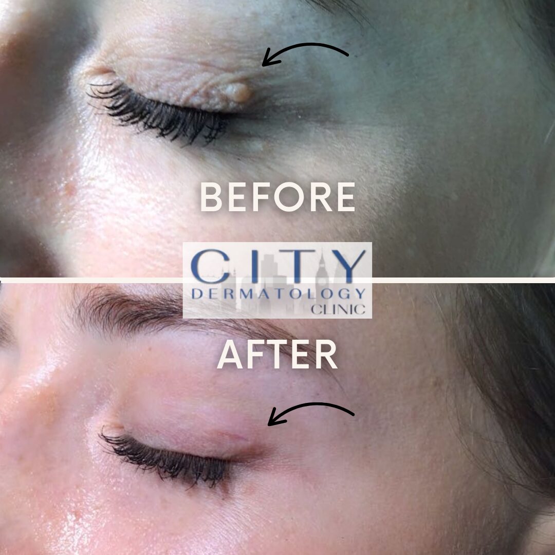 Before and After Photos Mole Removals