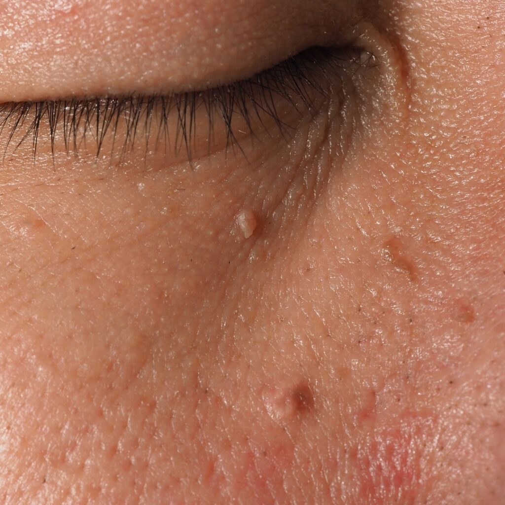 Facial Wart Removal London - Cosmetic Skin Experts