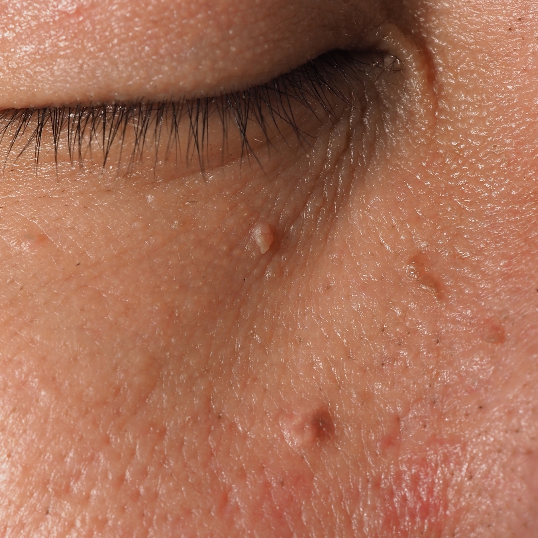 Facial Wart Removal London - Cosmetic Skin Experts