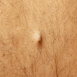 Sebaceous Cyst Removal London - Private Skin Surgery Clinic