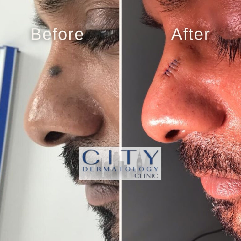 Before and After Photos Mole Removals