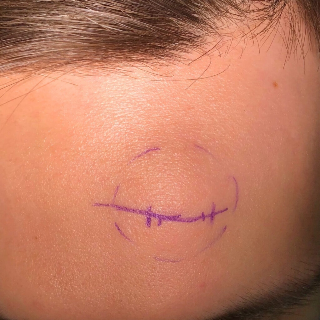 Before and After Lipoma Removal Results