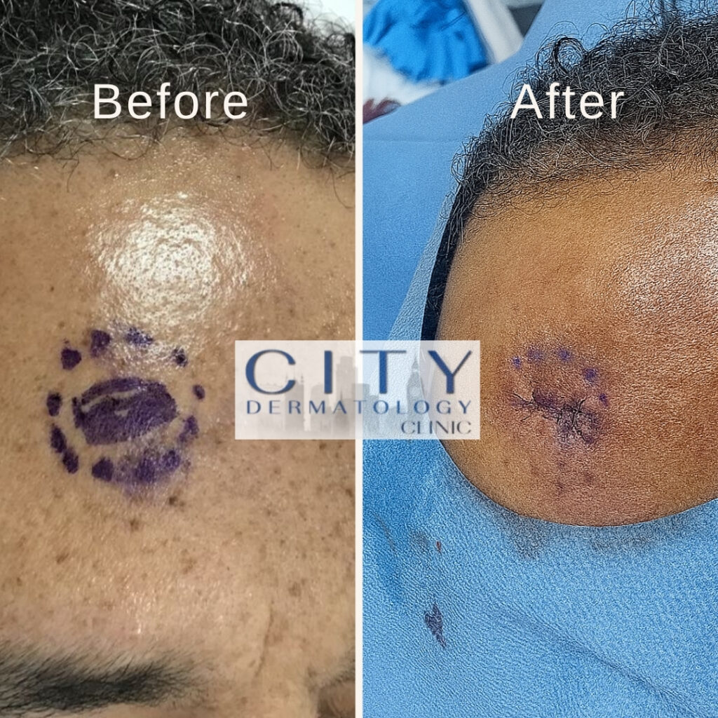 Before and After Lipoma Removal Results