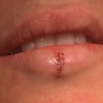Mole on Lower Lip Removal | Excision Surgery & Healing