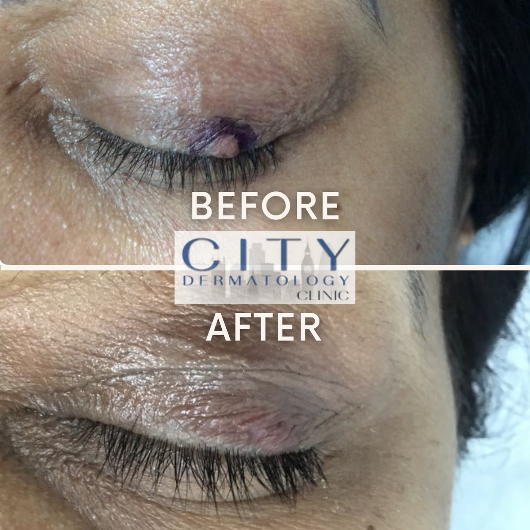 Eye Cyst (Chalazion) Removal London from £375 | Same Day Treatment