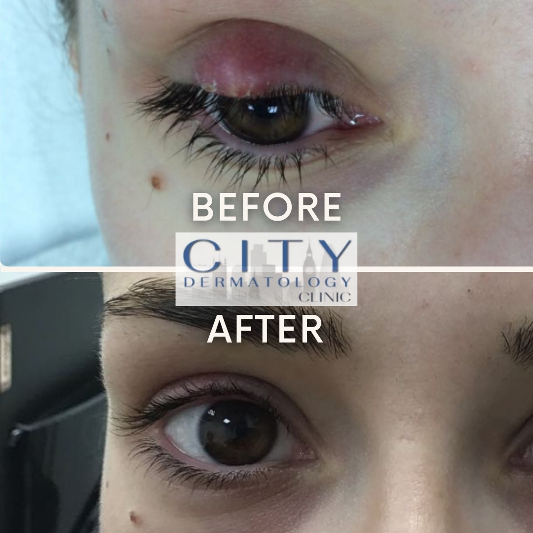 Eye Cyst (Chalazion) Removal London from £375 | Same Day Treatment