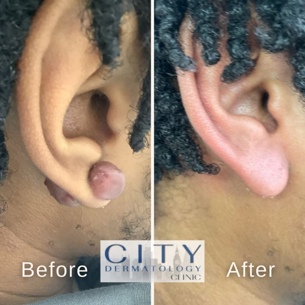 Keloid Scar Removal in London from £295 | Same Day