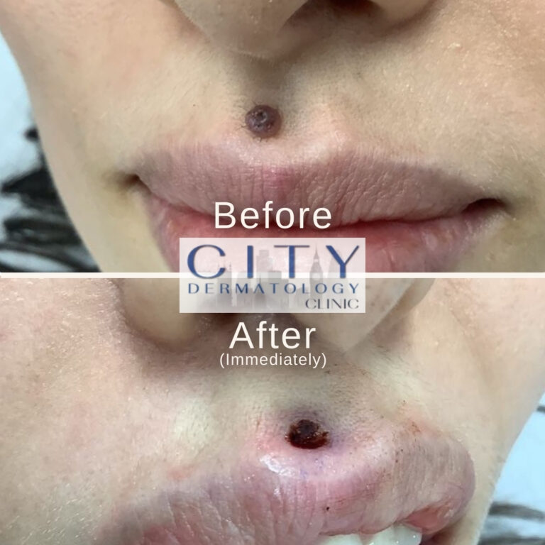 Before and After Photos Mole Removals