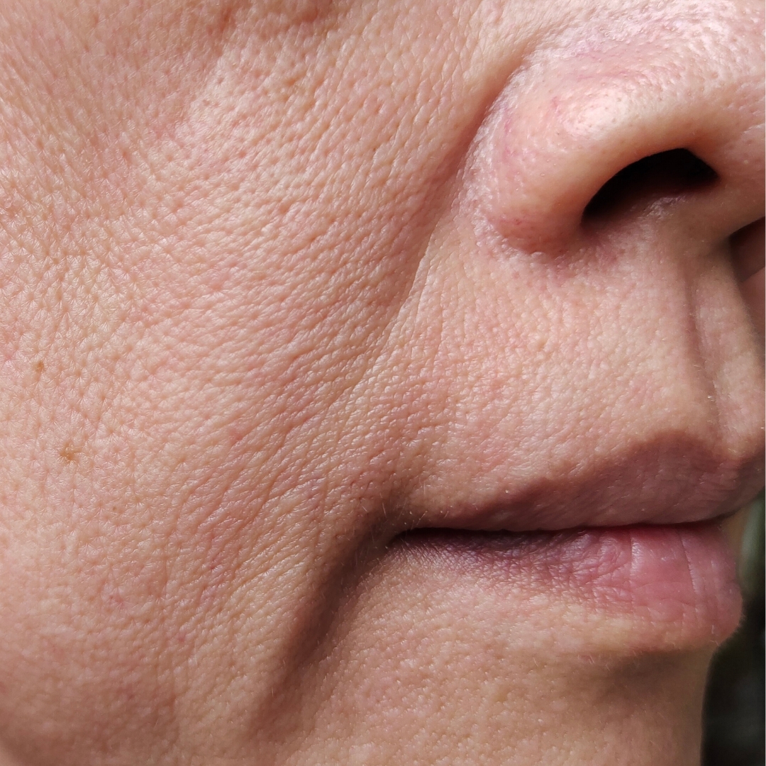 Fillers for Smokers’ Lines | Smooth Vertical Lip Wrinkles