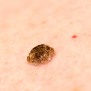 Is Mole Removal Covered by the NHS? What You Need to Know ...