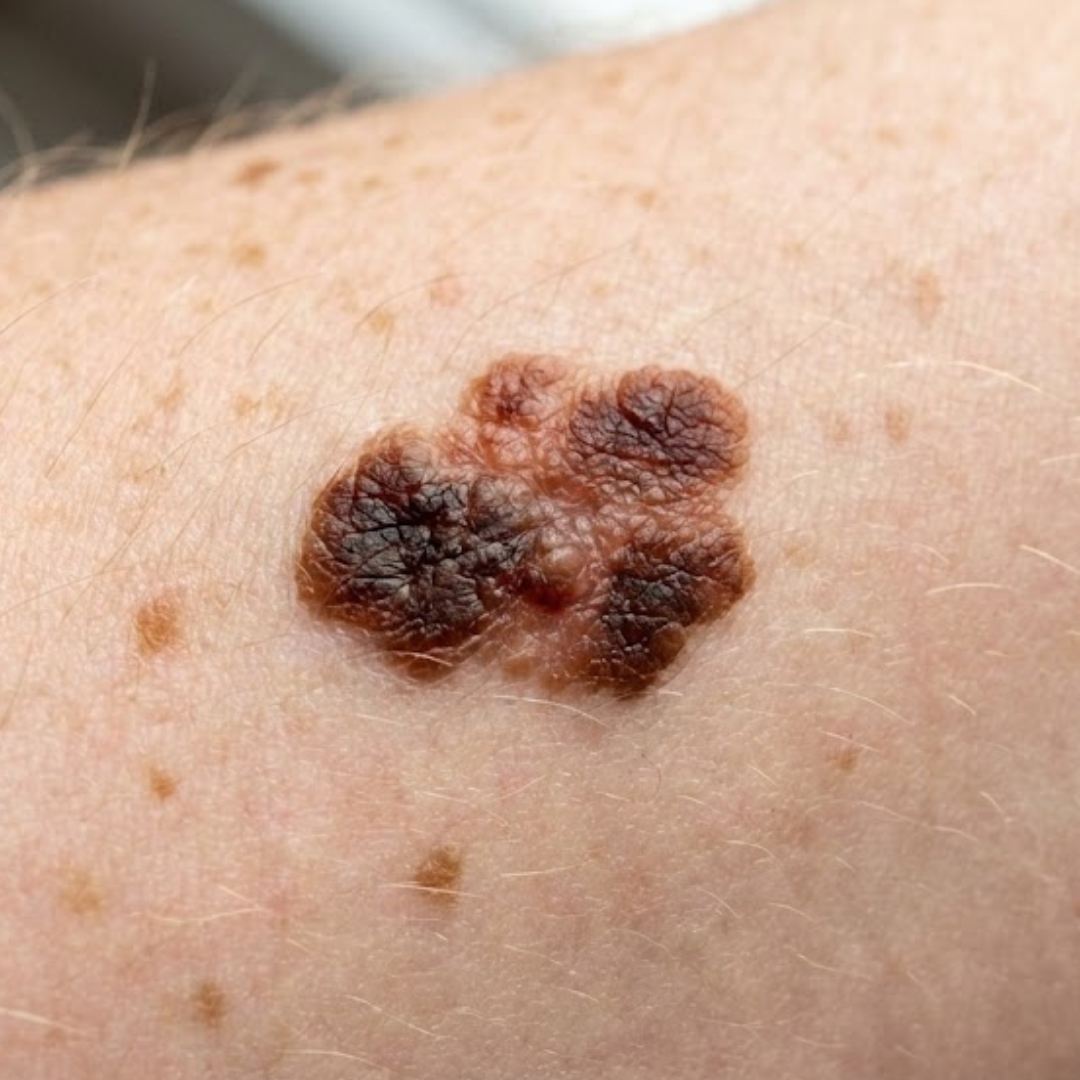 Suspicious Mole Removal in London: What Dermatologists Look For