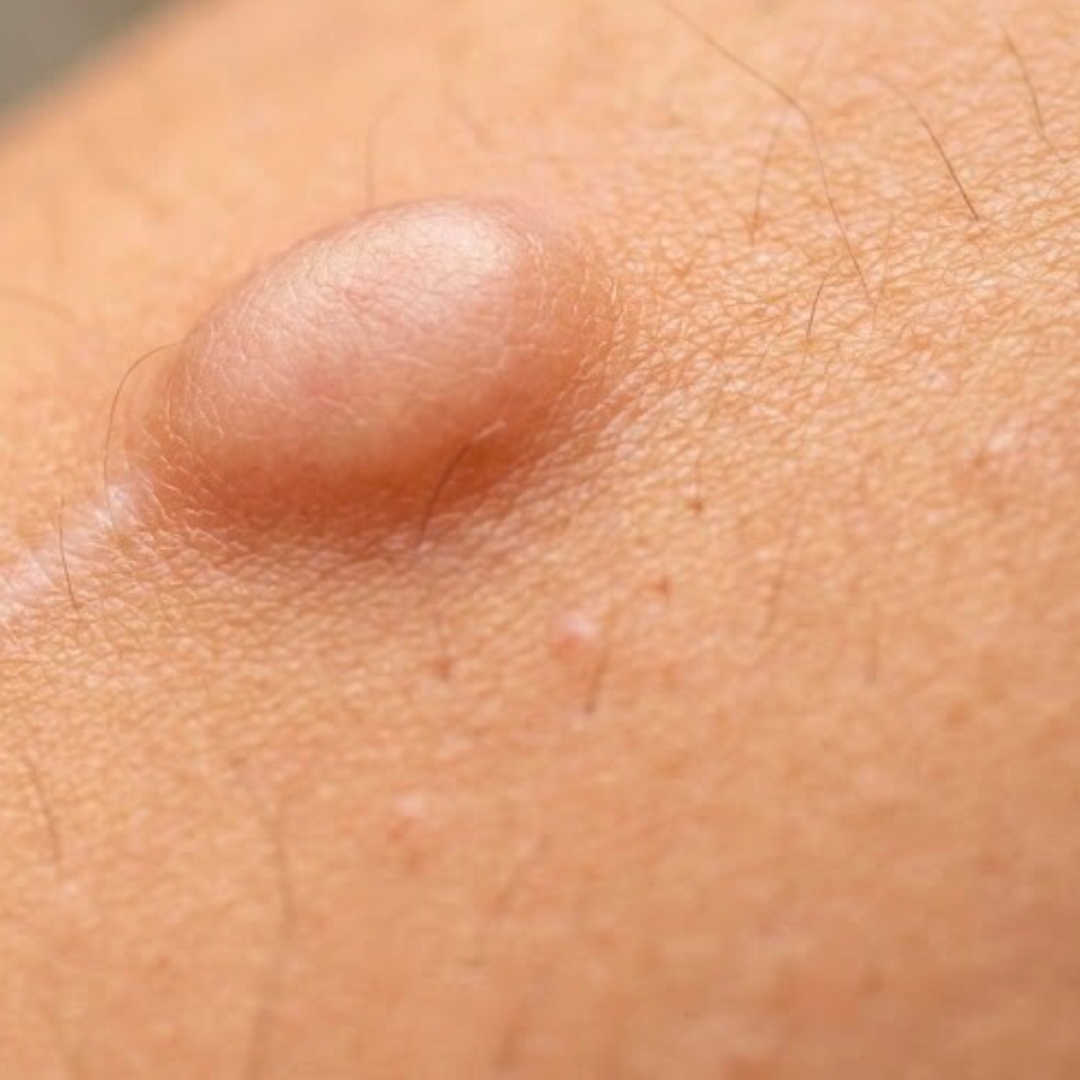 Cyst Removal Procedures | Clinical Cases January 2026