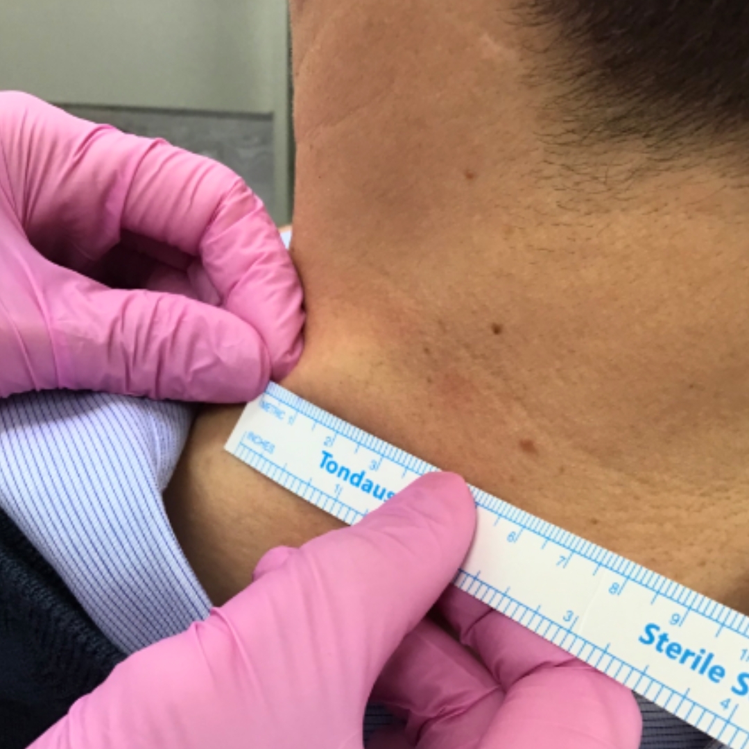 Lipoma on the Neck: Assessment and Removal