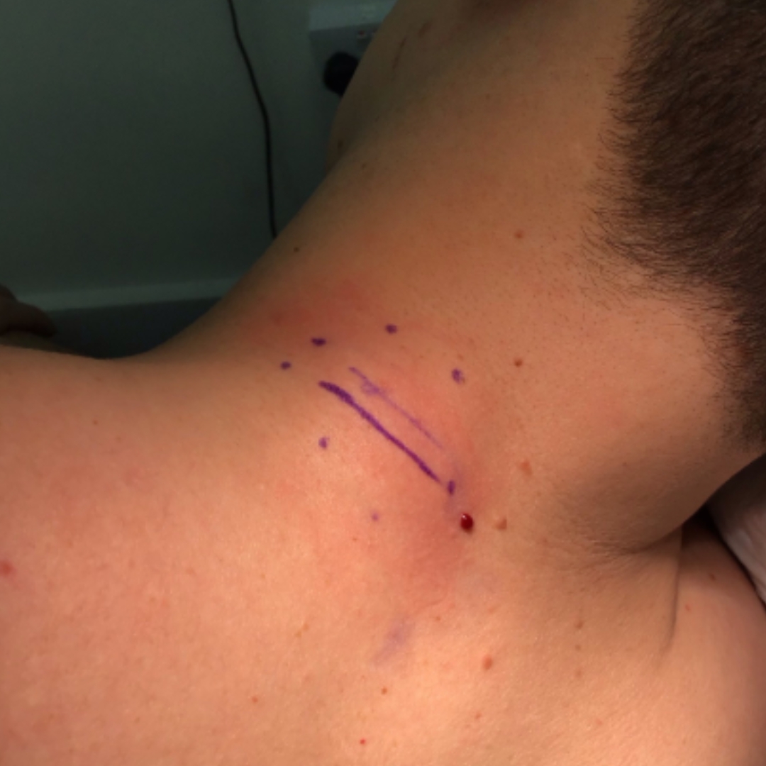 Lipoma on the Neck: Assessment and Removal
